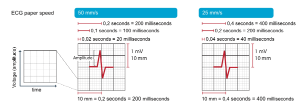 ECG Interpretation Made Simple – MOC Stepwise Approach